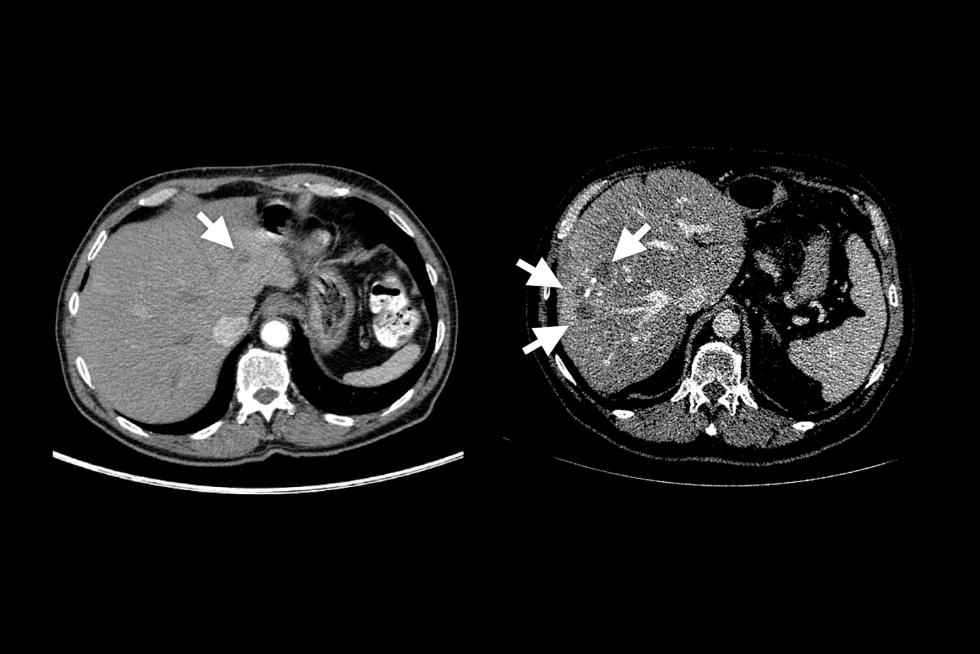 Johns Hopkins researchers create artificial tumors to help AI detect ... Johns Hopkins researchers create artificial tumors to help AI detect ...